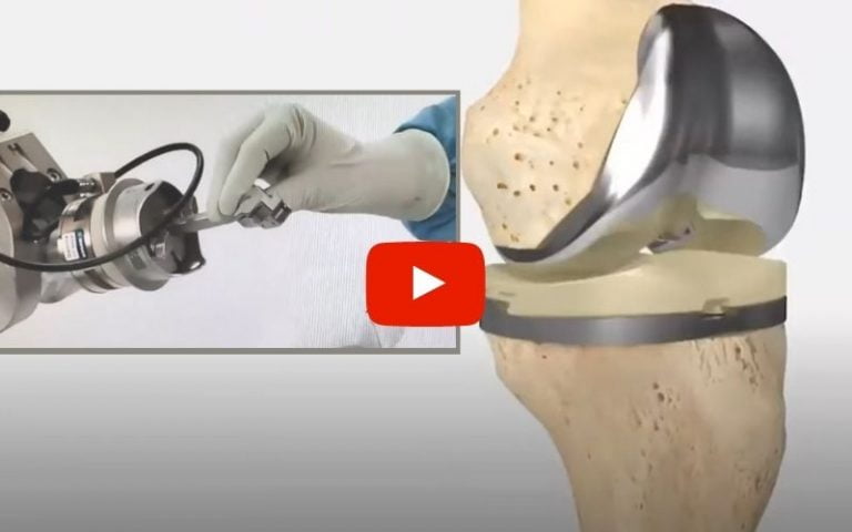 Robotic Knee Replacement: Everything you need to know - Montefiore ...