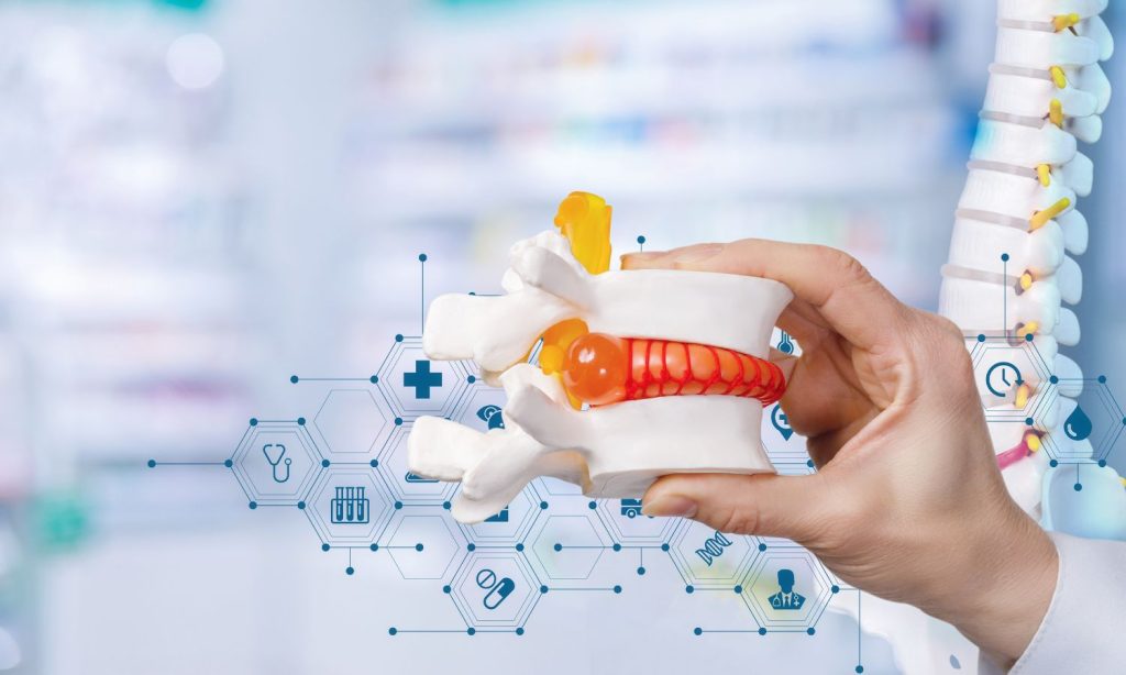 All About Herniated Disks - Northeast Orthopedics and Sports Medicine